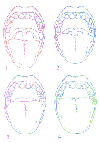 Mallampati Classification – 5minuteairway