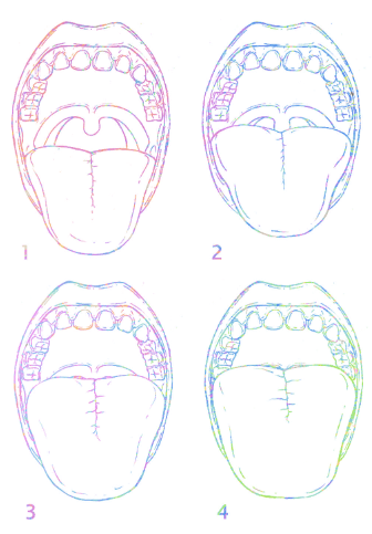 Mallampati Classification – 5minuteairway