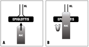 The Hyoepiglottic Ligament – 5minuteairway